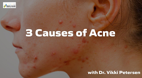 3 Causes of Acne - Video