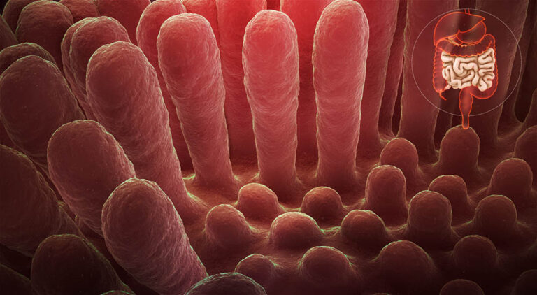 Celiac Disease? Villous Atrophy is not Required for Diagnosis